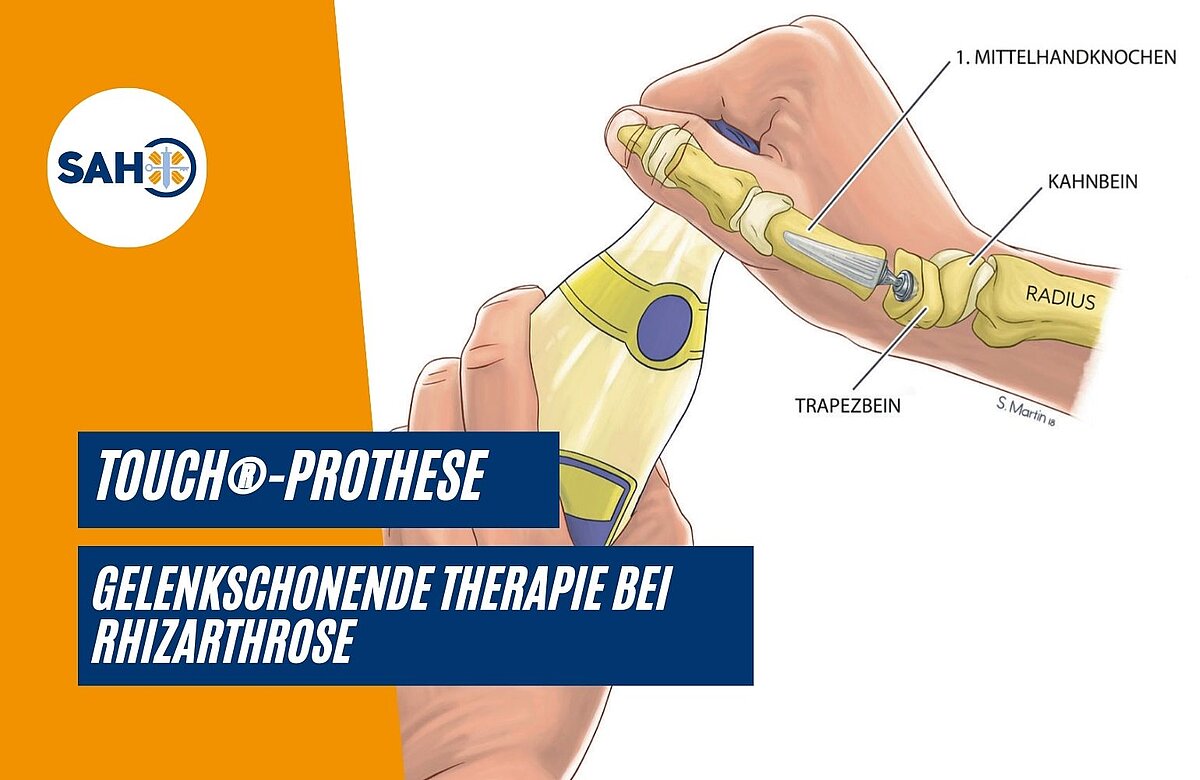 Video: Touch-Prothese ® bei Rhizarthrose - St. Antonius Hospital Eschweiler